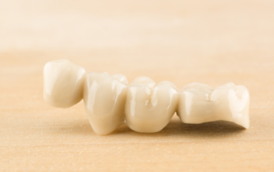 Dental Bridge: Cost, Procedure, Types, & Alternatives | Thrive Dental ...